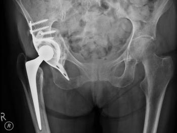 Reviews of the Stryker Exeter Hip